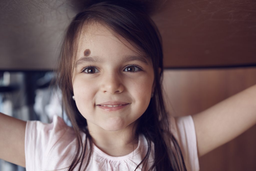 Muttermale Hautmale - Kinderkrankheiten